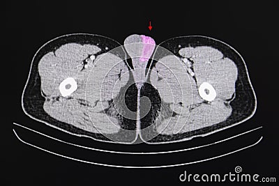 A CT Scan Of A Patient With Testicular Cancer Stock Image ...