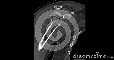 CT Scan Of Shoulder Joint In Case Fracture Shoulder Joint Royalty-Free ...