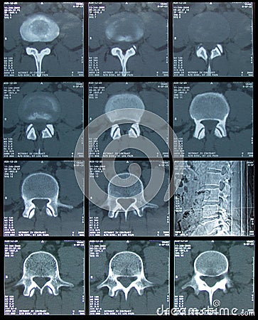 CT Scan Of Spine Stock Image - Image: 63371