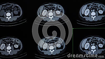 CT Scan of a Whole Abdomen of a Patient. Stock Footage - Video of ...