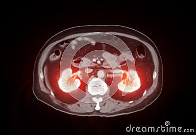 CTA Of Aorta And Major Branches:.A Comprehensive CTA Scan Showing The ...