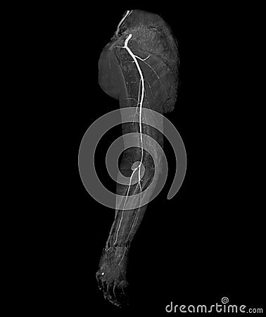 CTA Brachial Artery Or CT Scan Of Upper Extremity 3D Rendering Image ...