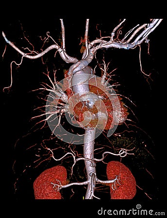 CTA Thoracic Aorta 3D Rendering Image Stock Photo | CartoonDealer.com ...