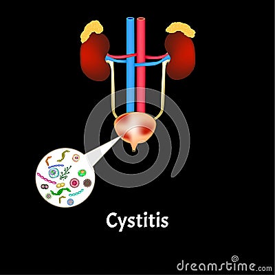 Cystitis. Inflammation Of The Bladder. The Structure Of The Kidneys And ...