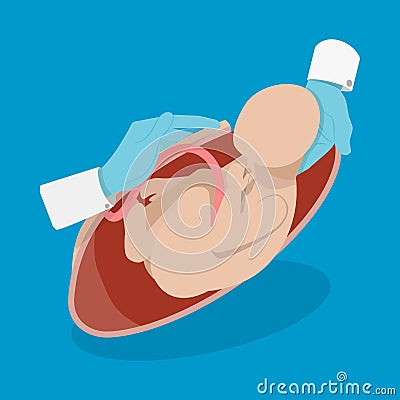 3D Isometric Flat Vector Illustration Of Cesarean Section ...