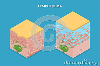 3D Isometric Flat Vector Illustration Of Lymphedema | CartoonDealer.com ...