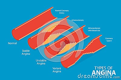 3D Isometric Flat Vector Illustration Of Types Of Angina ...