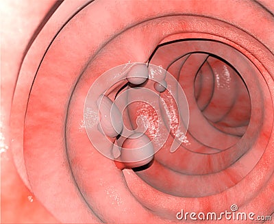 3d Illustration Of The Intestinal Polyps Stock Image | CartoonDealer ...