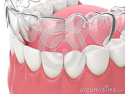 3d Render Of Invisalign Removable Retainer With Lower Jaw Stock Photo ...