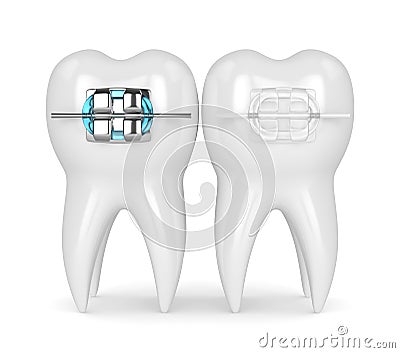 3d Render Of Teeth With Ceramic And Metal Braces Stock Photography ...