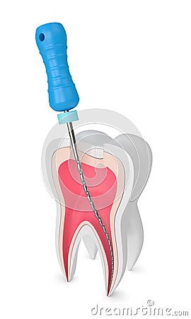 3d Render Of Tooth With Endodontic File Royalty-Free Stock Image ...
