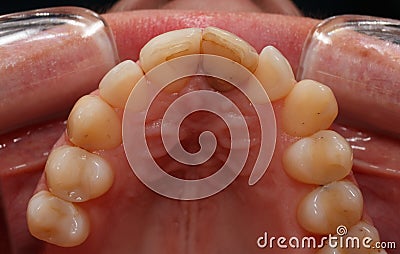 A Dark Front Tooth Protruding From The Tooth Row. A View Of The Teeth ...