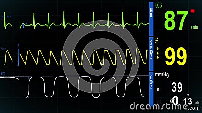 Electrocardiogram, ECG, Hartmonitor Stock Footage - Video of hartslag ...
