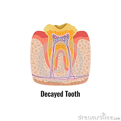 Decayed Tooth Poster Vector Illustration | CartoonDealer.com #227161192
