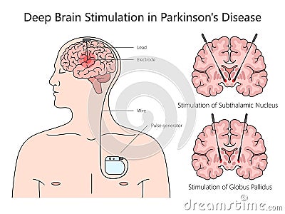 Deep Brain Stimulation Diagram Medical Science Royalty-Free ...