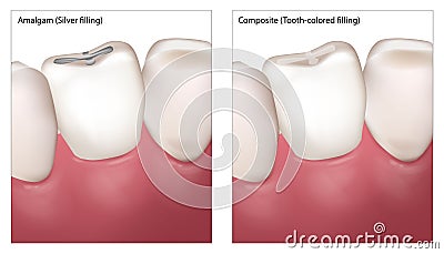 Dental Filling Procedure. Amalgam Silver Filling And Composite Tooth ...