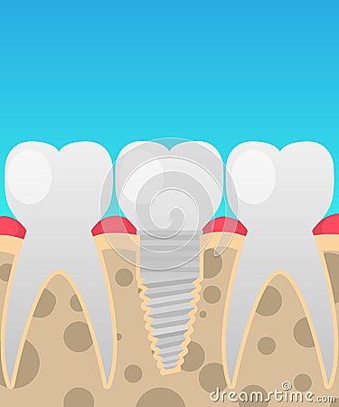 Dental Implants, Tooth Replacement, Vector Illustration In A Cartoon ...