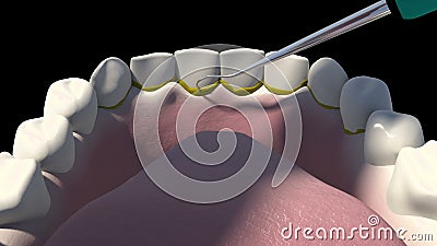 Dental scaling procedure stock video. Video of shows - 193393819