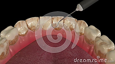 Dental scaling procedure stock video. Video of shows - 193393819