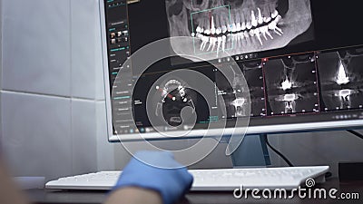 Dentist Doctor Examines a Panoramic X-ray of the Jaw on a Computer ...