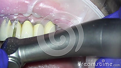 Dentistry. Video Filming Under a Microscope Stock Footage - Video of ...