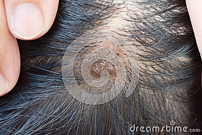 Dermatitis In Hair Or Skin Disease On The Head Stock Photo - Image ...