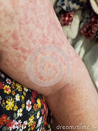 Dermatitis On A Womans Arm Rash Blotches Stock Photography ...