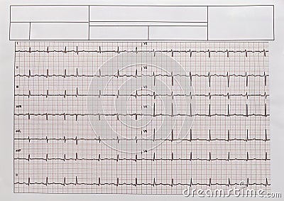 Detailed EKG, ECG, Electrocardiogram Showing Heartbeat Patterns ...