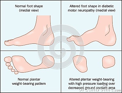 Diabetic Foot Stock Vector - Image: 54143830
