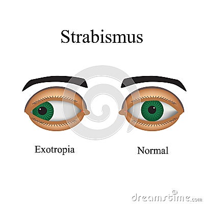 Diseases Of The Eye - Strabismus. A Variation Of Vector Illustration ...