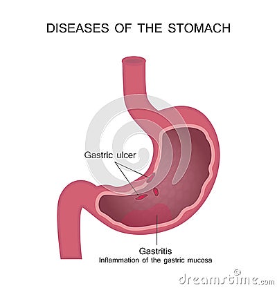 Diseases Of The Stomach. Peptic Ulcer And Gastritis. Cartoon Vector ...
