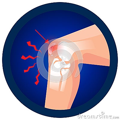 Meniscus Injury Of Knee Icon. Vector Flat Design For Radiology ...