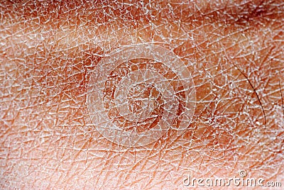 Dry Skin Texture Royalty Free Stock Photography - Image: 18622837
