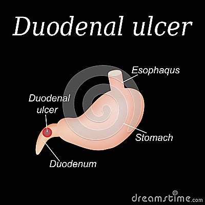Duodenum Ulcer Affected. Duodenal Ulcer. Vector Illustration On A Black ...