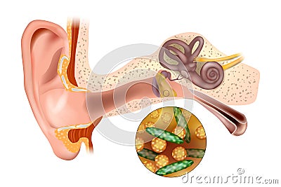 Ear Infection Middle Ear. Bacterial Ear Infection. Streptococcus ...