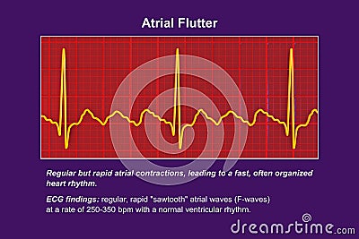 ECG In Atrial Flutter, An Abnormal Heart Rhythm Characterized By Rapid ...