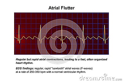 ECG In Atrial Flutter, An Abnormal Heart Rhythm Characterized By Rapid ...