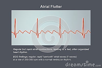 ECG In Atrial Flutter, An Abnormal Heart Rhythm Characterized By Rapid ...