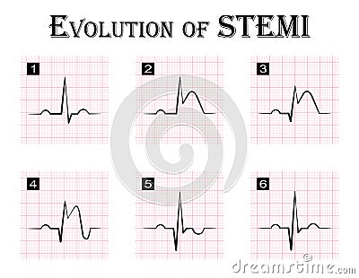ECG Of Evolution ( Step By Step ) Of STEMI Cartoon Vector ...