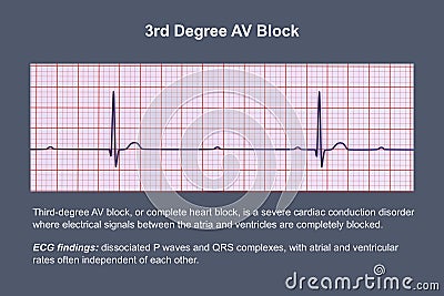 ECG Of 3rd Degree AV Block, 3D Illustration | CartoonDealer.com #323667350