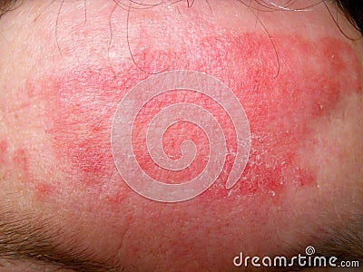 Eczema Stock Image - Image: 36696361