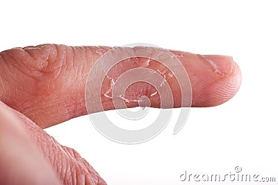 Shingles, Zoster or Herpes Zoster Symptoms on Arm Stock Photo - Image ...