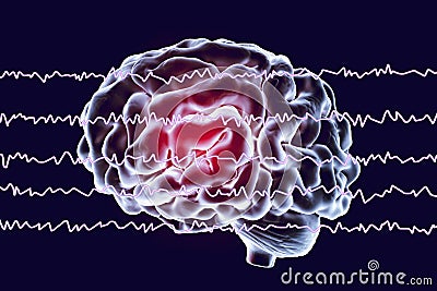 EEG Electroencephalogram, Brain Wave In Awake State With Mental ...