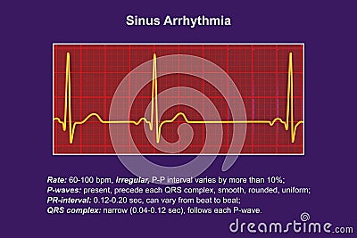 Electrocardiogram ECG Displaying Sinus Arrhythmia, 3D Illustration ...