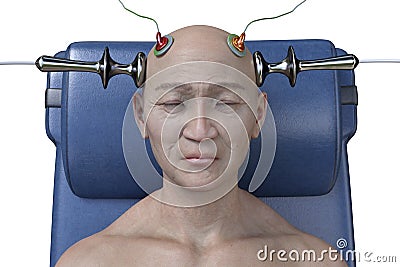 Electroconvulsive Therapy, ECT, A Treatment Involving The Use Of ...
