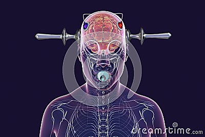 Electroconvulsive Therapy, ECT, A Treatment Used For Severe Mental ...