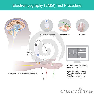 Electromyography Test Procedure. EMG Vector Illustration ...