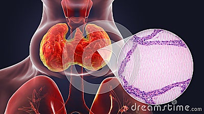 Endemic Goiter, 3D Illustration And Light Micrograph | CartoonDealer ...