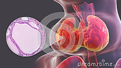 Endemic Goiter, 3D Illustration And Light Micrograph Royalty-Free ...