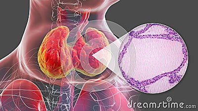 Endemic Goiter, 3D Illustration And Light Micrograph | CartoonDealer ...